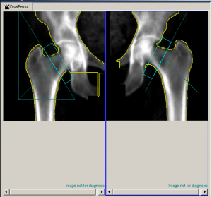 Bone Densitometry - Robin K Dore MD, Inc.